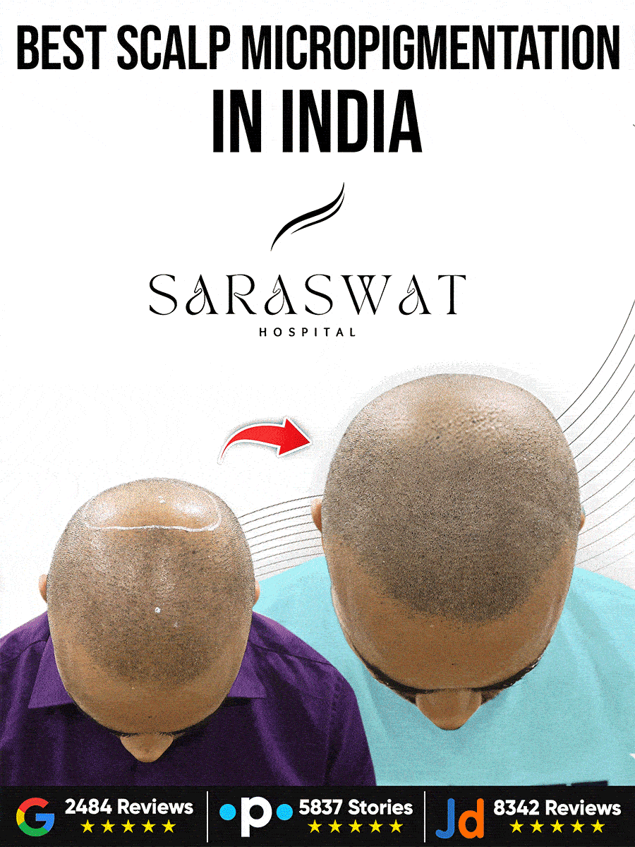 Scalp Micropigmentation in India by ABHRS Certified Doctors