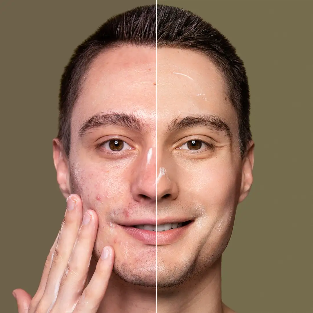 Truncal Acne Scars: A Guide to Diagnosos and Management